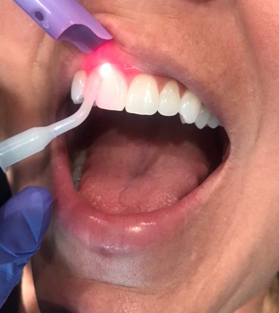 So, you want to be a laser dental hygienist? | Dentistry IQ