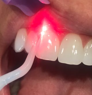 What's the difference between LAPT and LBR? | Dentistry IQ