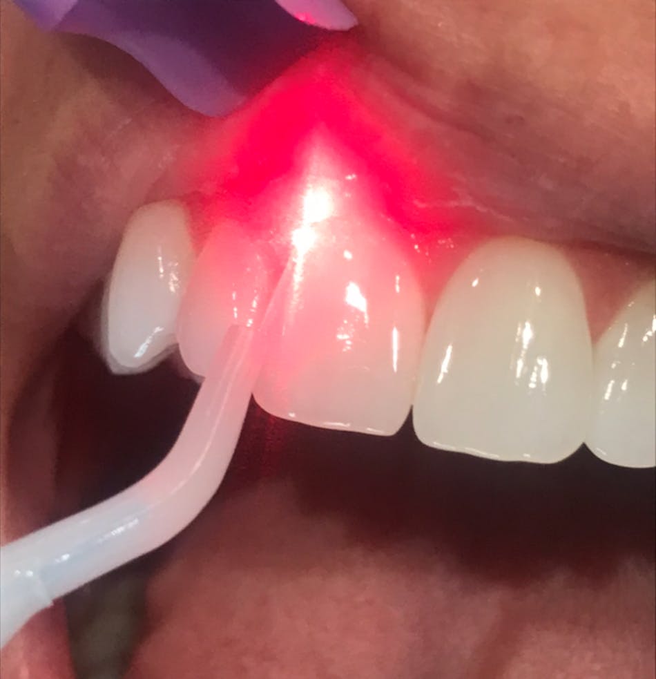 What's the difference between LAPT and LBR? | Dentistry IQ