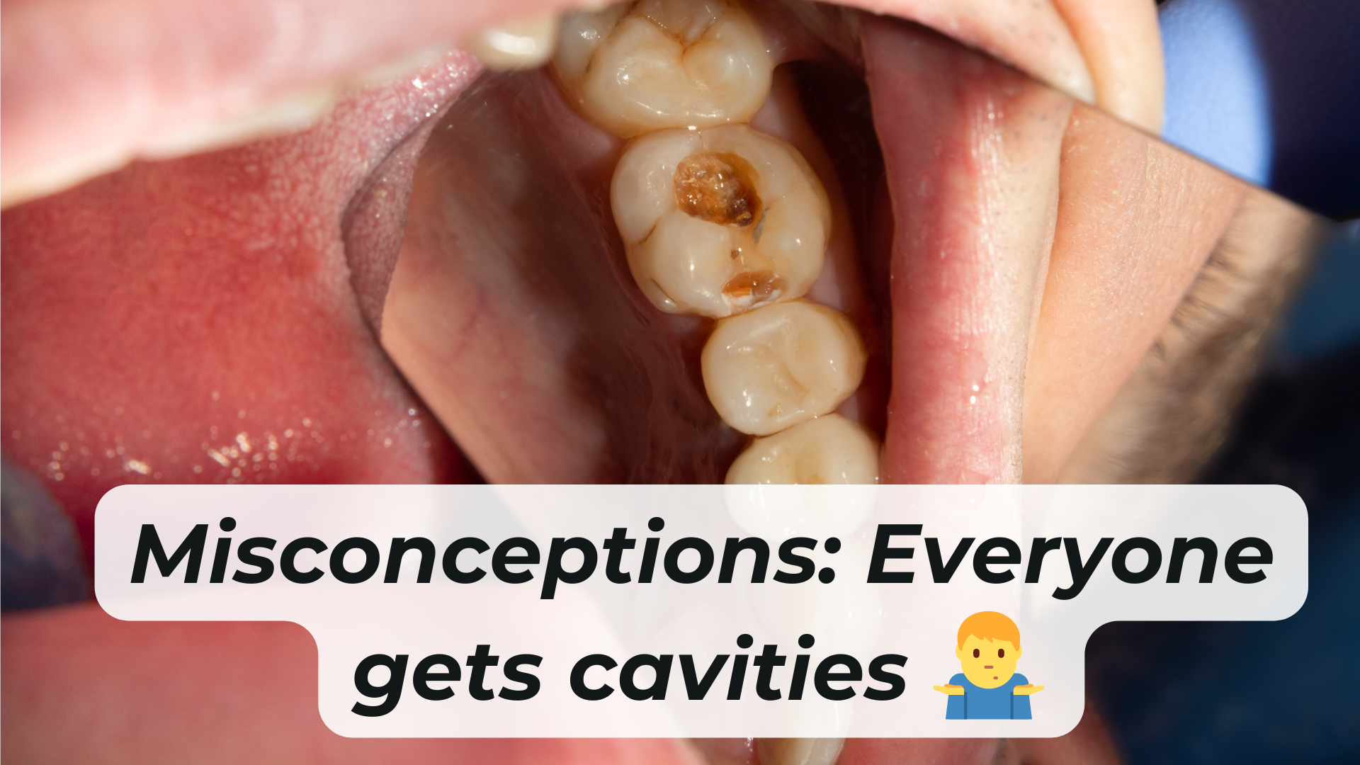 10 common misconceptions about cavities | Dentistry IQ
