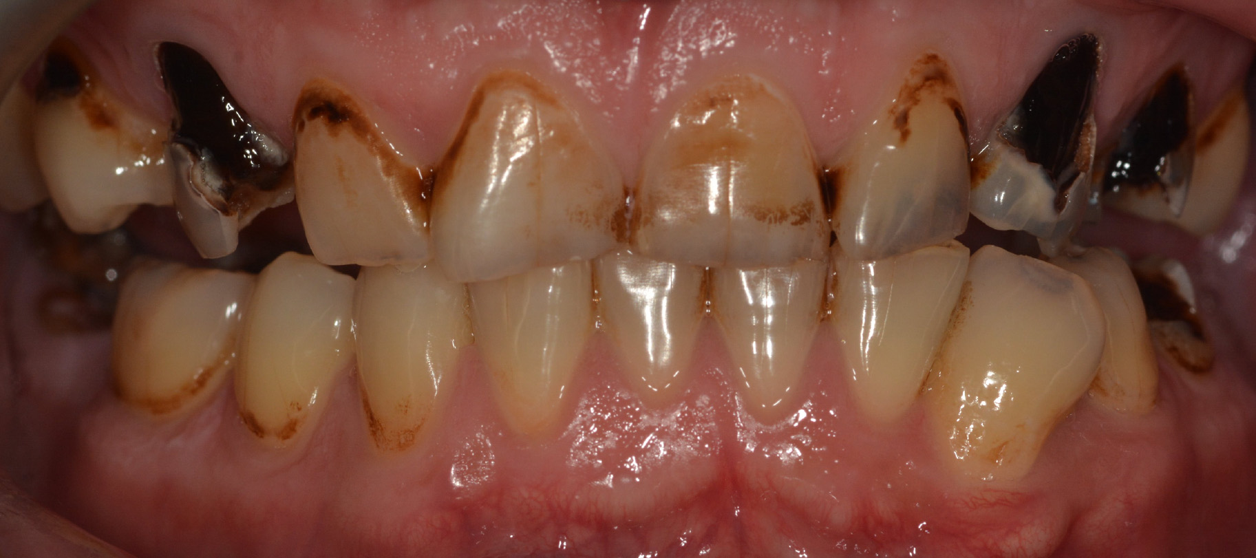Xerostomia Caries