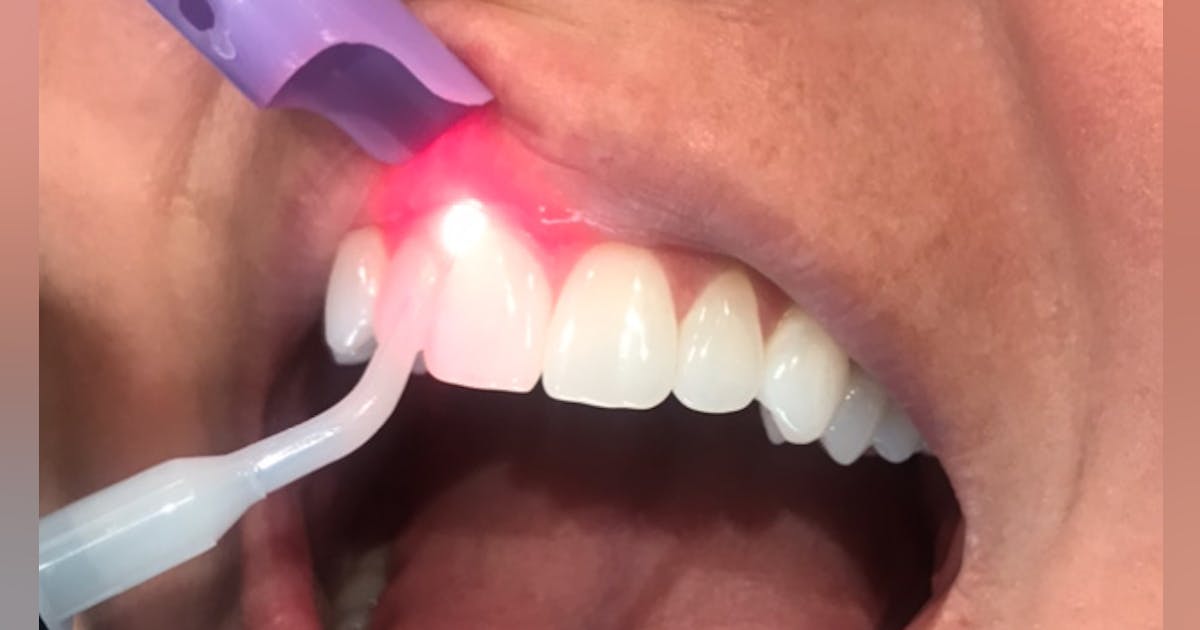 Your guide to using lasers in dentistry and dental hygiene | Dentistry IQ Your guide to using lasers in dentistry and dental hygiene | Dentistry IQ