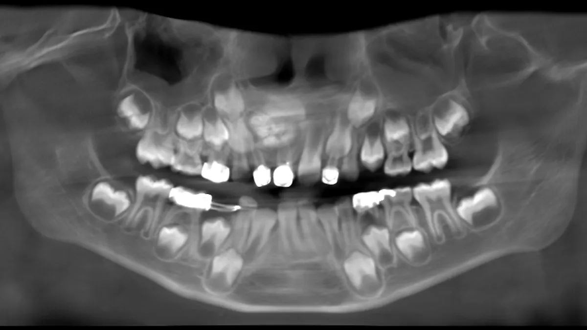 Diagnosis and treatment for Breakthrough Clinical oral pathology case ...