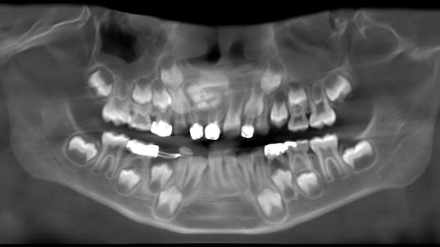 Diagnosis and treatment for Breakthrough Clinical oral pathology case ...