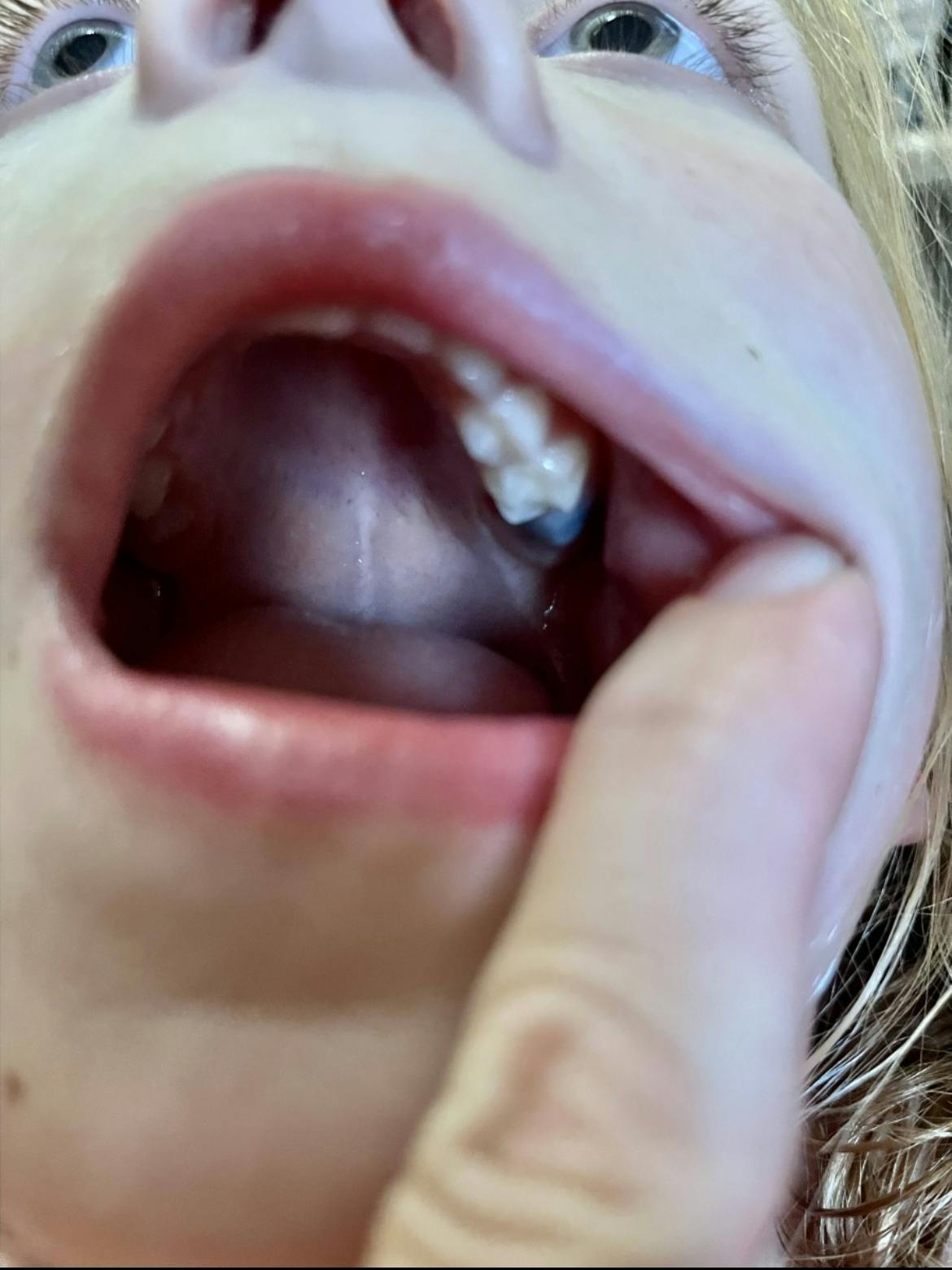 Eruption Cyst Baby Dr. Kimmy DDS | This Patient Presented To Our