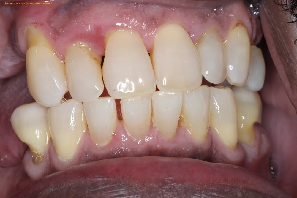 The clinical benefits of periodontal desiccation | Dentistry IQ