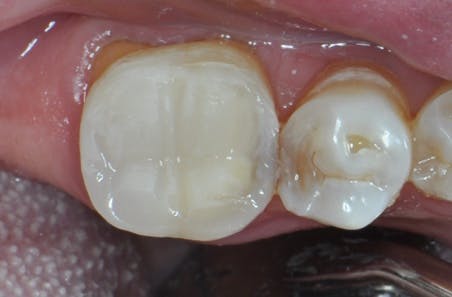 Pulpdent introduces next-generation bulk-fill dental restorative ...